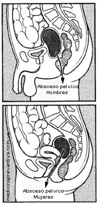¿Qué es un absceso pélvico? – COLAREBO